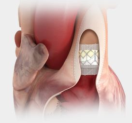 Edwards Sapien - XT - Devices - Transcatheter Heart Valves ...