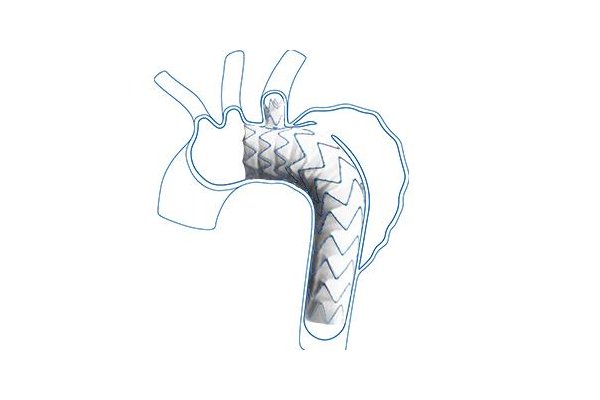 Castor - Healthcare Professionals - Endovascular - Branched ...