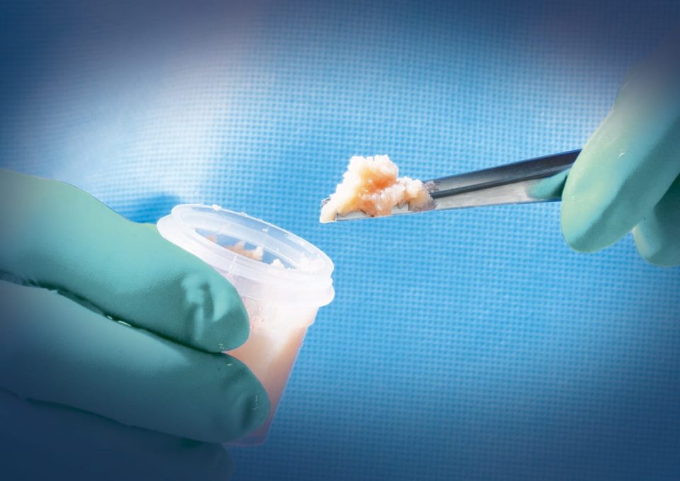 Trinity Evolution - Spine - Biologics - Allograft with Viable ...