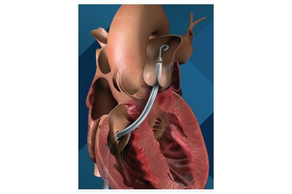 Impella RP Minimally Invasive Right-Sided Heart Pump