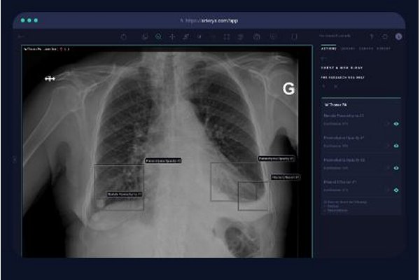 Arterys | MSK AI Emergency Department Chest X-ray Software