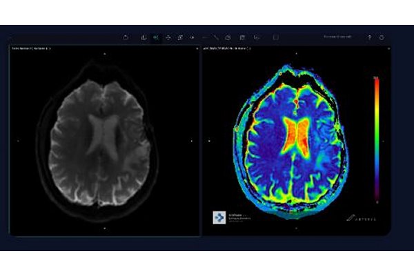 Arterys Neuro AI Neuro-Radiology Software