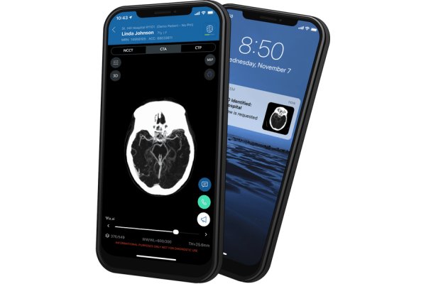 A.I. Viz LVO - A.I. Detection - Suspected Large Vessel ...