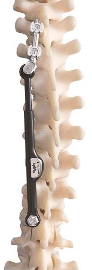 ApiFix - MID-C - Scoliosis - Adolescent Idiopathic Scoliosis ...