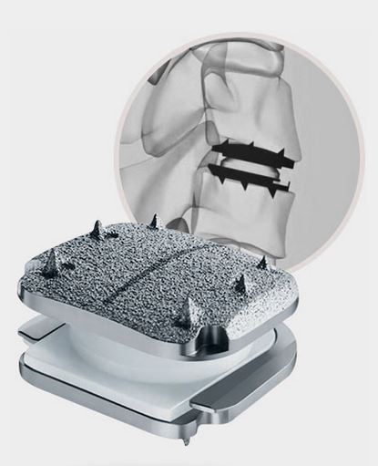 Prodisc - C - Vivo - Cervical - Anterior Cervical Total Disc ...