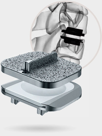 Prodisc C Nova - Cervical - Anterior Cervical Total Disc ...