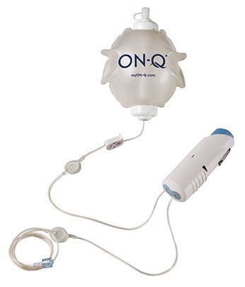 Avanos ON-Q Pump With Ondemand Bolus Button