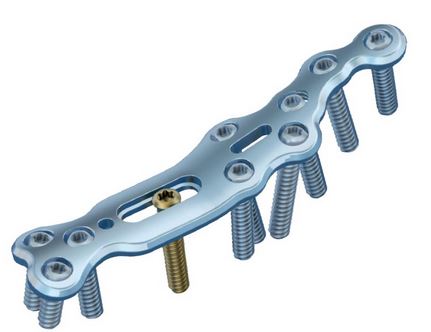 TriLock - MTP-1 - 2.8 - Lower Extremities - Aptus - Foot