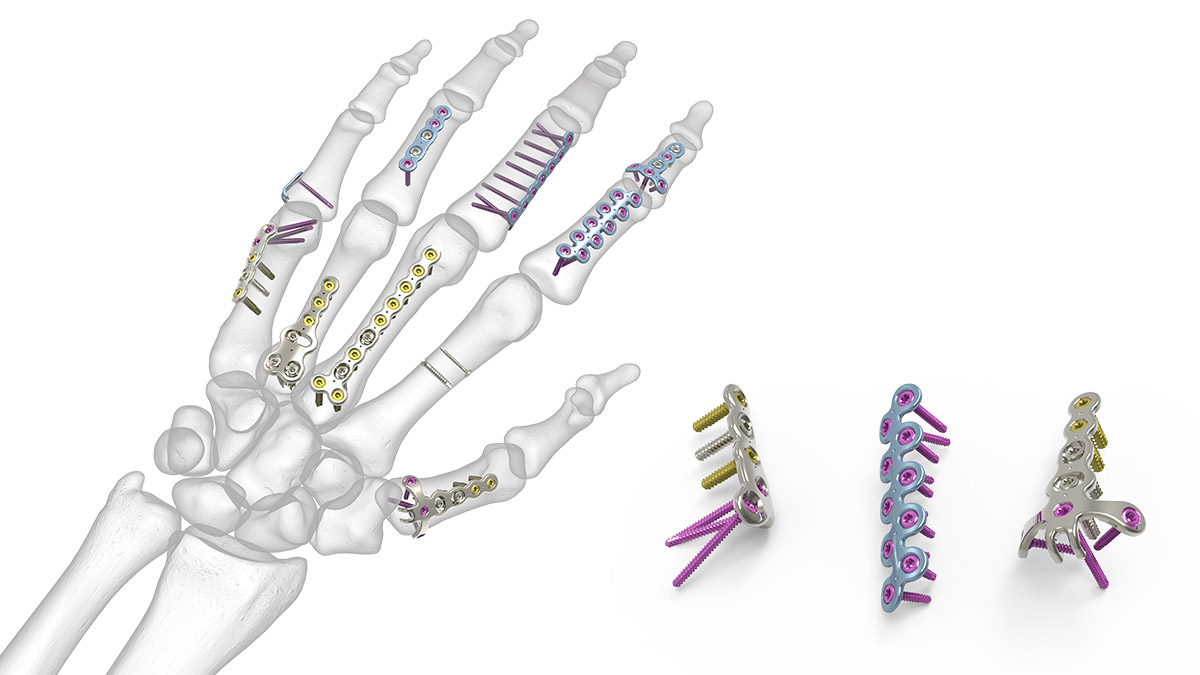 Acumed - Hand & Wrist - Hand Fracture System by Acumed LLC