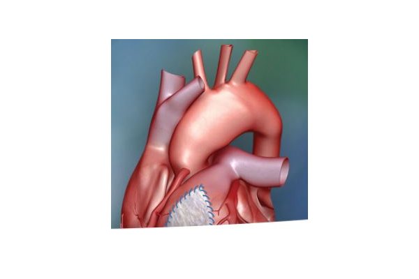 ProxiCor - CTR - Cardiac and Vascular Surgery - Extracellular ...