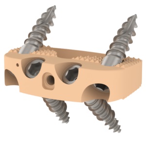 Medicrea IMPIX ALIF SA Anterior Stand-Alone Lumbar Cage