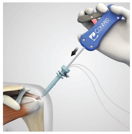 Poplok 2.8/3.3Mm Knotless Suture Anchors