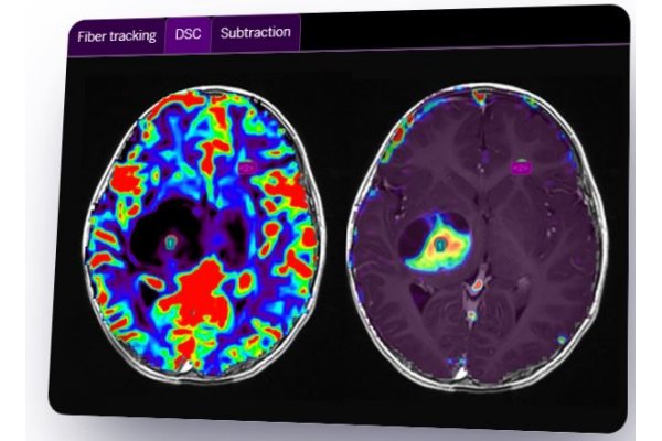 Olea Sphere 3.0 Neurology Imaging Analysis Software for Improved ...