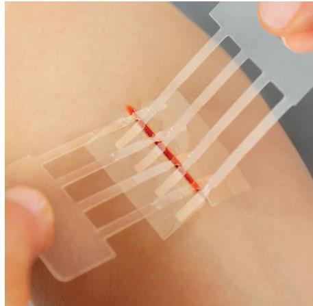 Clozex - 2 - Emergency Laceration Closures - Emergency ...