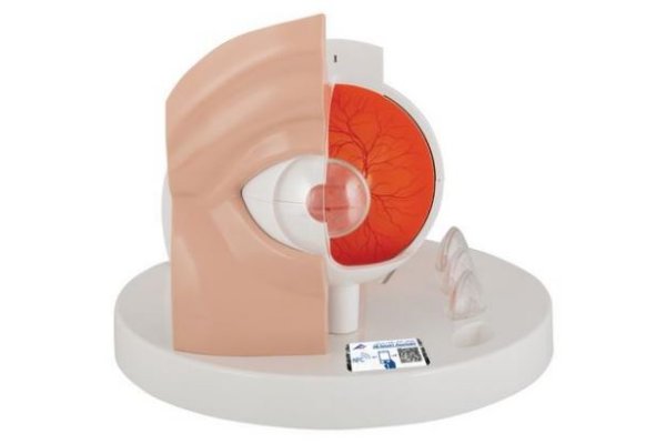 3B Scientific Pathological Human Eye Model - 3B Smart Anatomy
