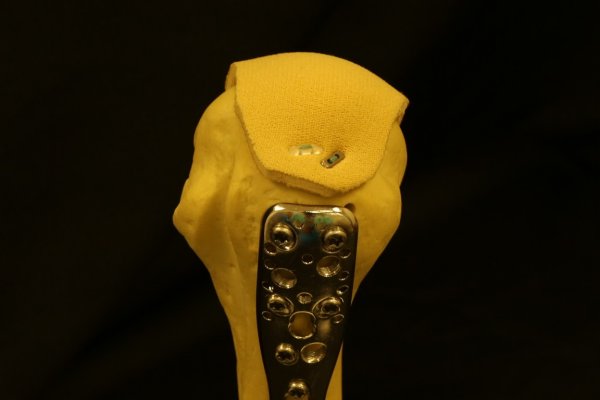 Bonutti TRANSET Fracture Fixation System