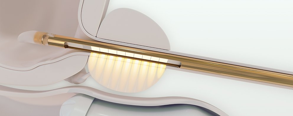 TULSA-PRO - Inside-Out Prostate Disease Ablation System by ...