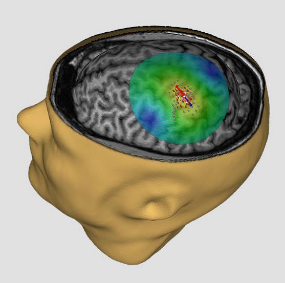 NBT - Navigated Brain Therapy System For Alleviating Chronic ...