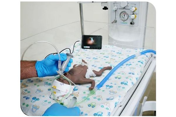 Neoview Neonatal Video Intubation System