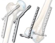 MAT - DHSP/DCSP - Orthopaedics Ortho/Trauma - Steel Dynamic ...