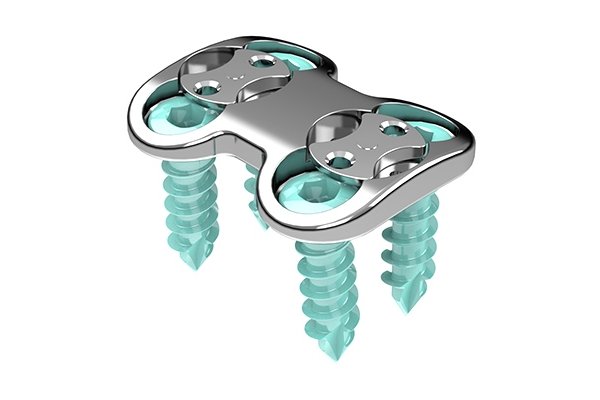 Origin - Spinal Systems - Plates - Anterior Cervical Plate by ...