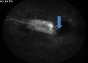 Cerevast - Microsphere-Mediated Ophthalmic Ultrasound by ...