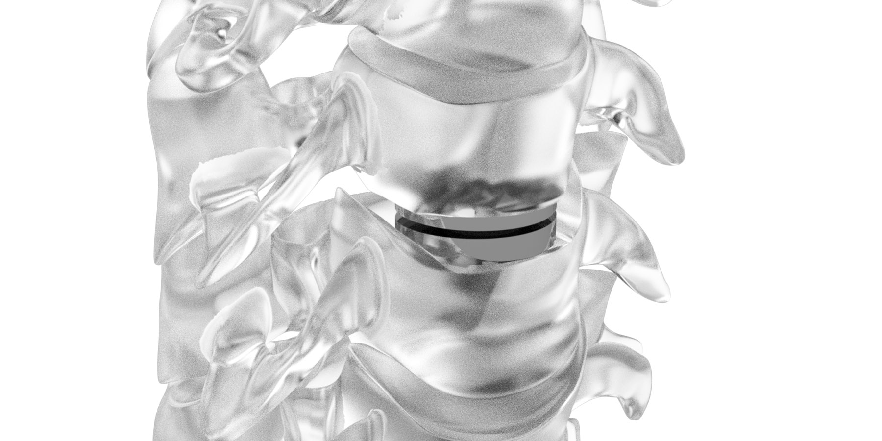 Neuro Dynalis-C Cervical Disk Prosthesis