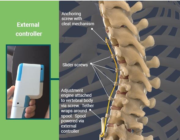 Auctus Dynamic Scoliosis Tethering System