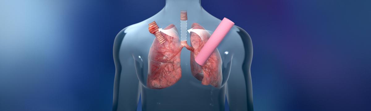 Biostage - Cellspan Implants - Cellspan Tracheal Implants by ...