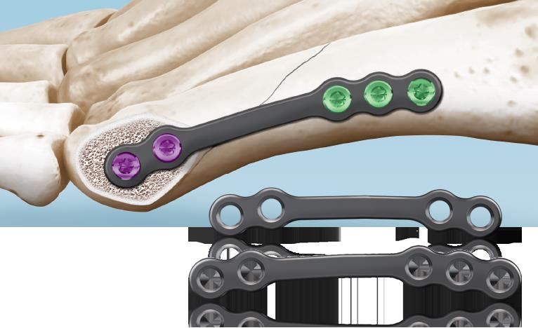 i2b 5MS - Lower Extremity Fracture System - Bunionette Plate ...