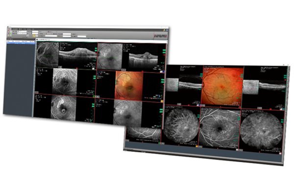 Geidelberg Heyex Pacs Eye Explorer Software Solution