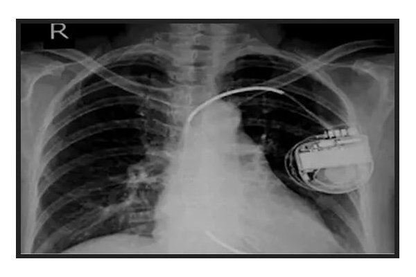 Medicomp TelePatch - Stress-Free Implantable Device ...