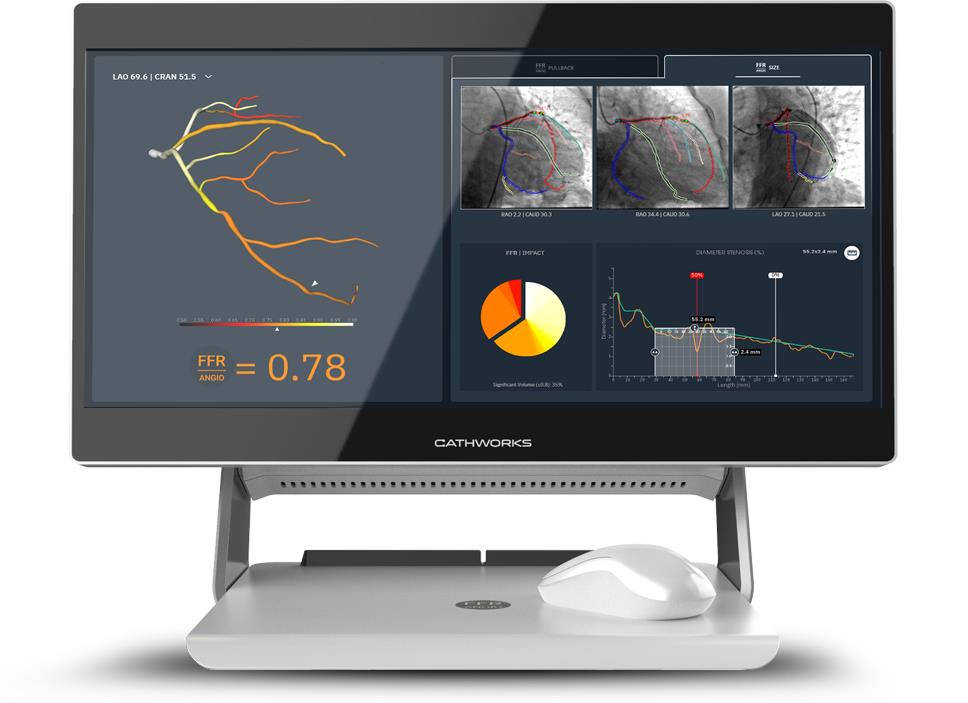 Cathworks Ffrangio - Advanced Angiograms System By Cathworks