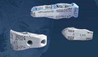 Aprevo - Spine Fusion Devices by Carlsmed, Inc.