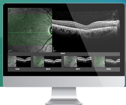 Notal OCT Computational Image Analyzer