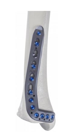 Tibia XLOC - Foot & Ankle - Distal Anterolateral Plate by AF ...