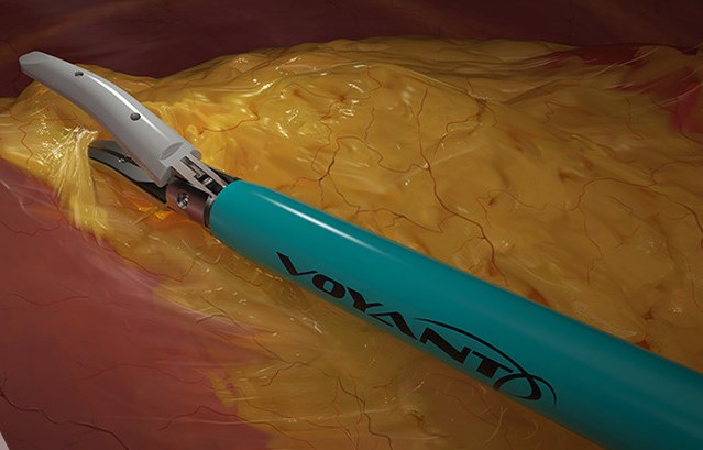 Voyant Maryland Fusion Device