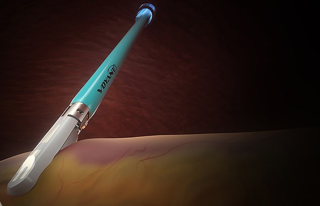 Voyant 5Mm Fusion Device