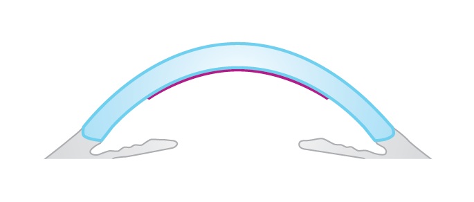 DMEK - Corneal Tissue - Descemet’s Membrane Endothelial ...