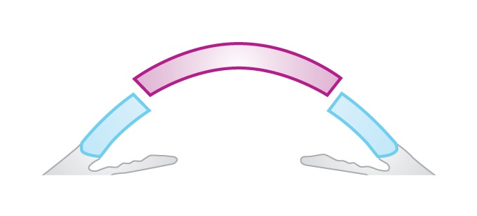 PKP - Corneal Tissue - Penetrating Keratoplasty by CorneaGen