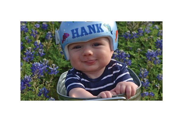 DOC Band - Plagiocephaly, Brachycephaly and Scaphocephaly ...