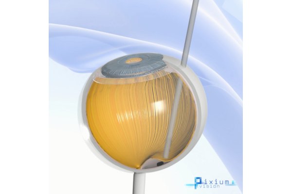Prima Bionic Vision System by PIXIUM VISION