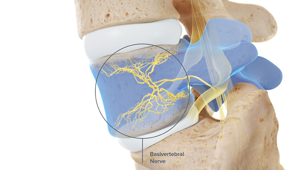 Intracept - Procedure by Relievant Medsystems, Inc.