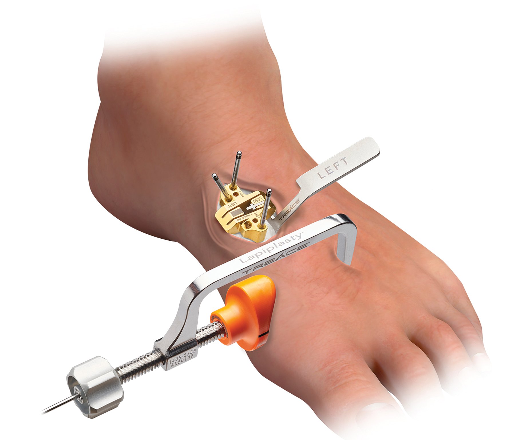 Lapiplasty Mini-Incision - Precision Instrument Set by Treace ...