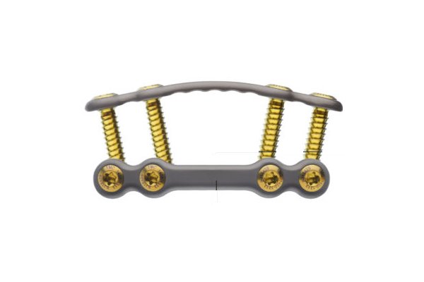 Lapiplasty Biplanar - SK23 - Anatomic Biplanar Implants