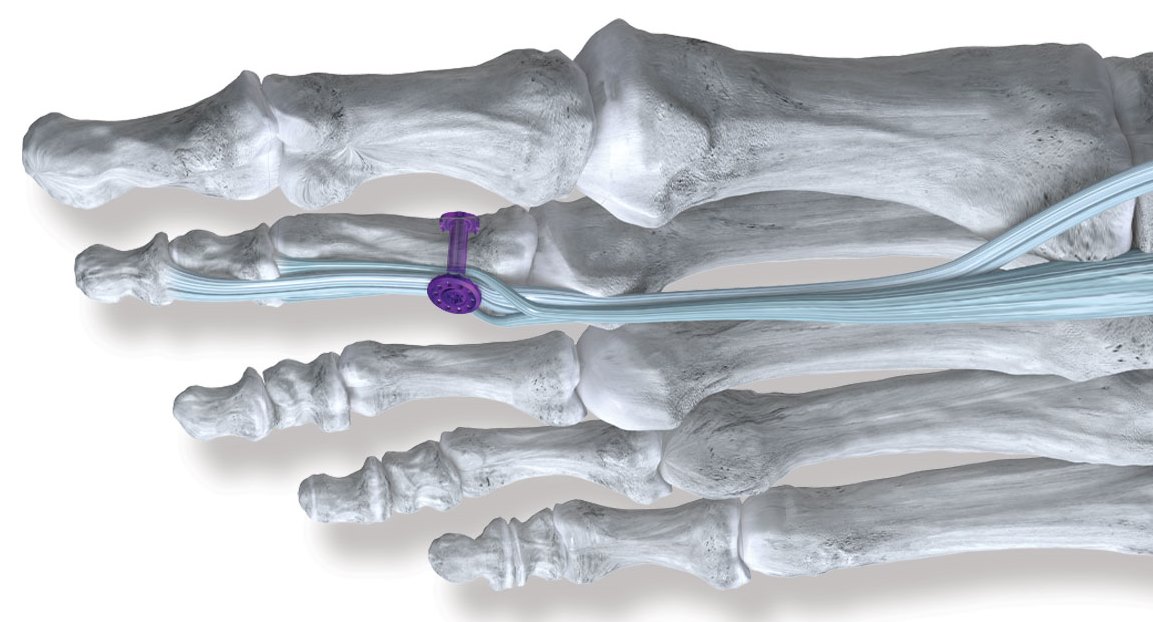TenoTac - 2.0 - Hammertoe Implants - Soft Tissue Fixation ...