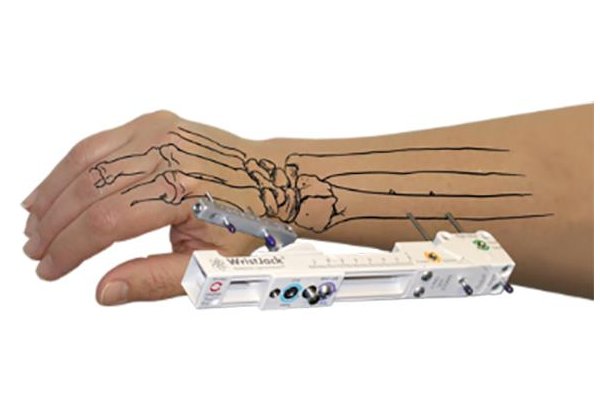 Agee WristJack - Incremental, Multiplanar Reduction for ...