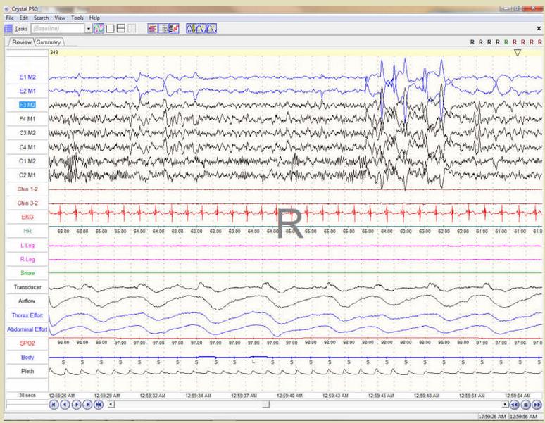 Cleveland PSG and Home Sleep Study Scoring Software