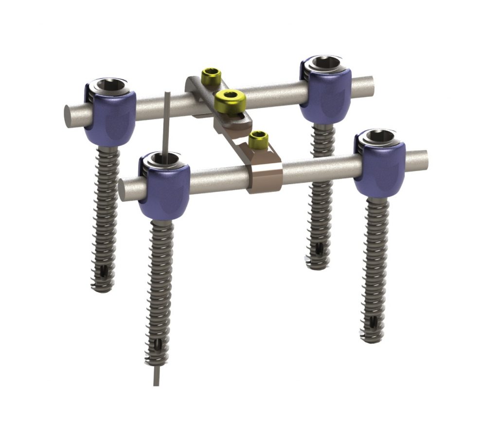 Aditus - Spinal - Thoracolumbar Stabilization - Spinal ...