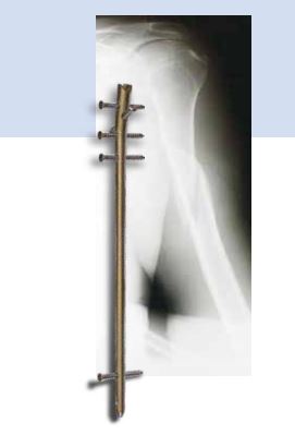 Traumatology & Orthopaedics - Humerus Interlocking Nail ...